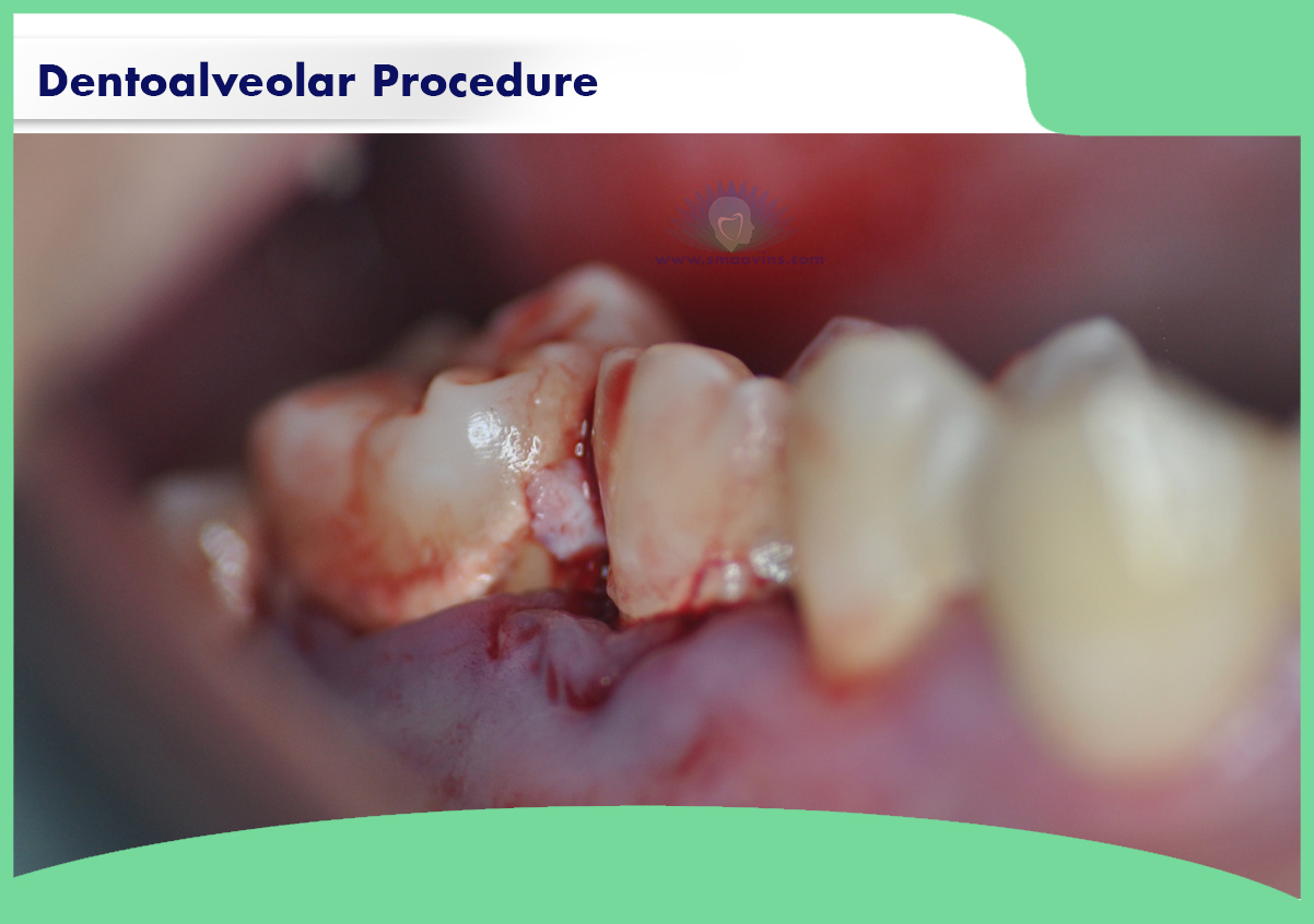 Best Dentoalveolar Procedure In Chennai, Now At Smaavins