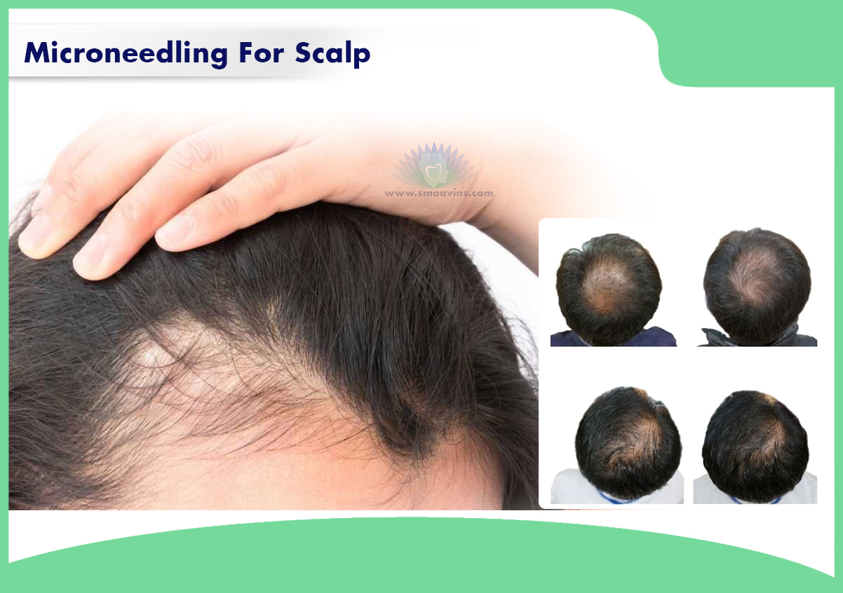 Microneedling For Scalp In Chennai | Smaavins Clinic