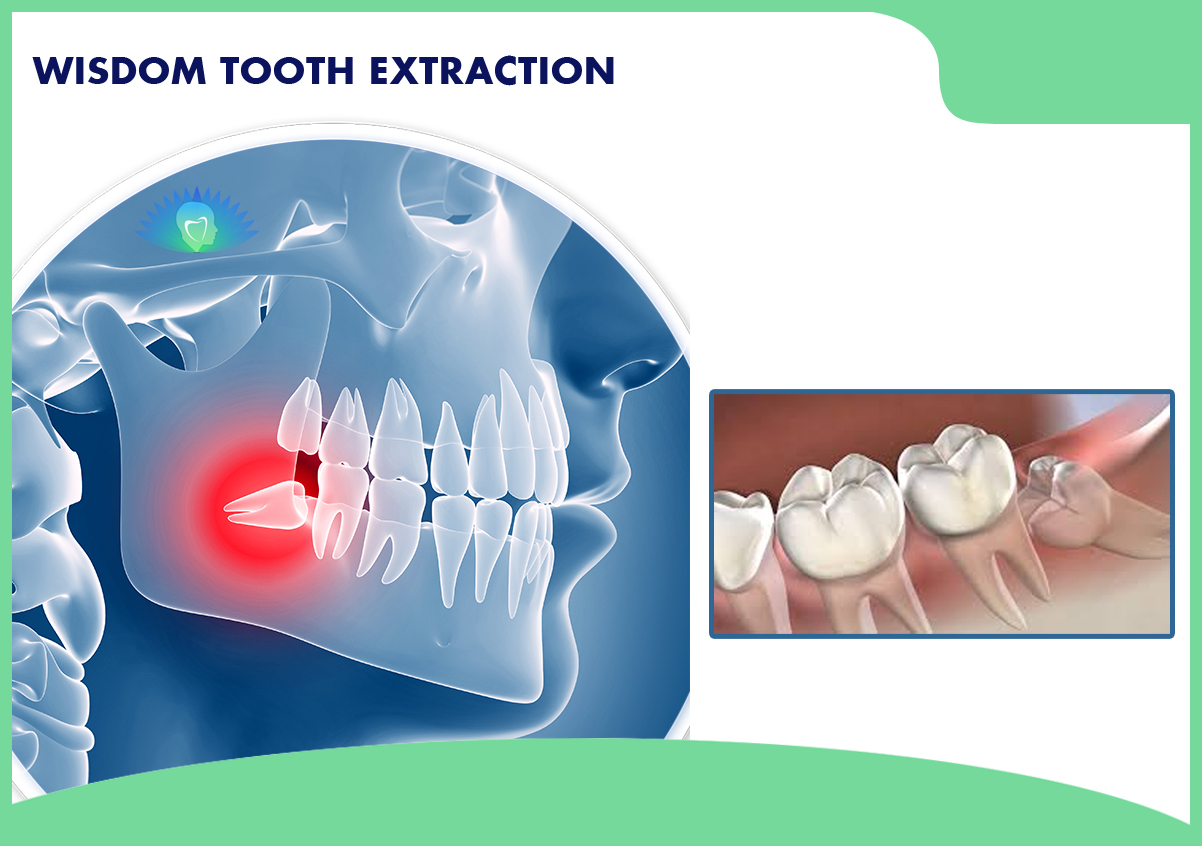 Wisdom Teeth And Mole Teeth Removal | Smaavins, Chennai