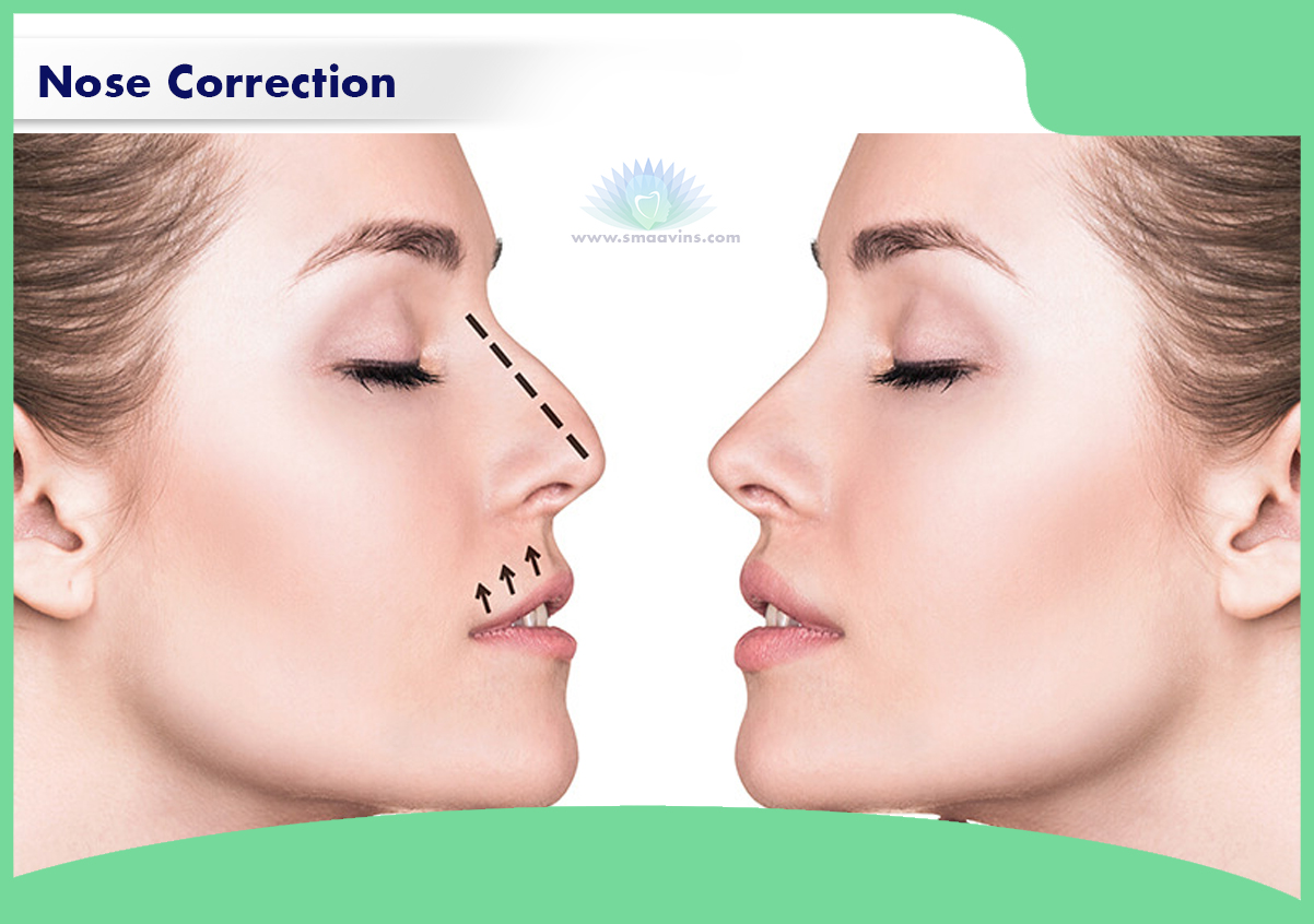 Best Nose Correction | Rhinoplasty | Smaavins, Chennai