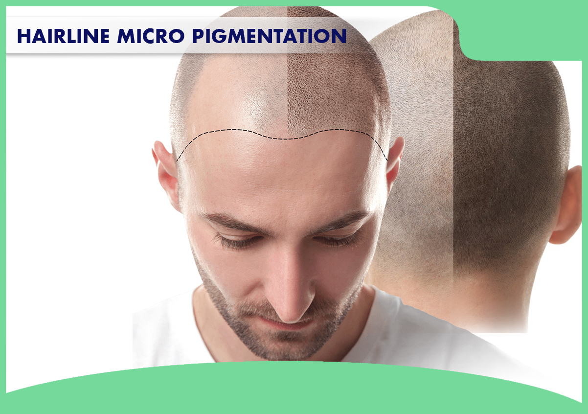 Best Hairline/scalp Micro Pigmentation | Smaavins, Chennai